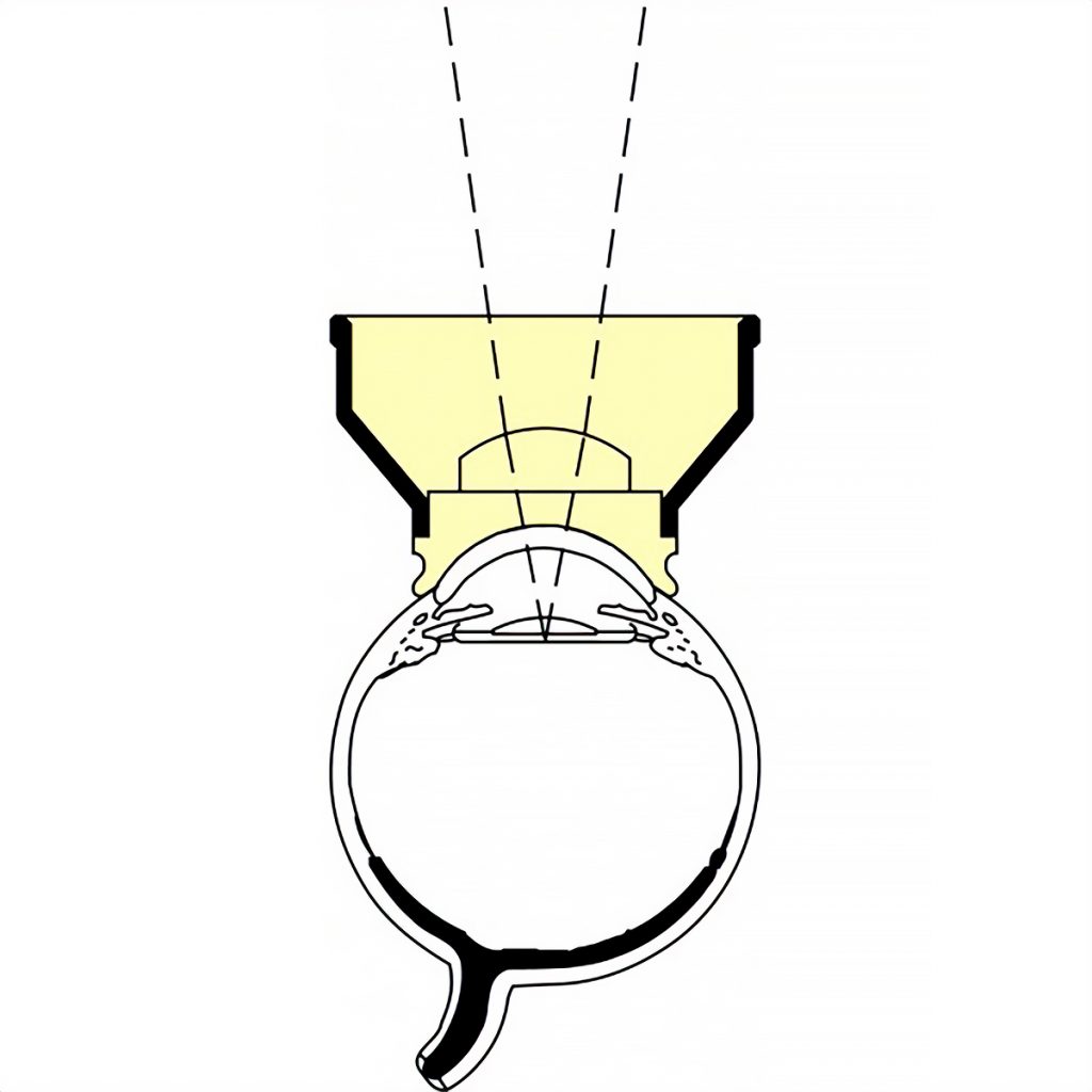 Viewlight Ocular MaxField 20D Indirect Lens - Ophthalmic Products